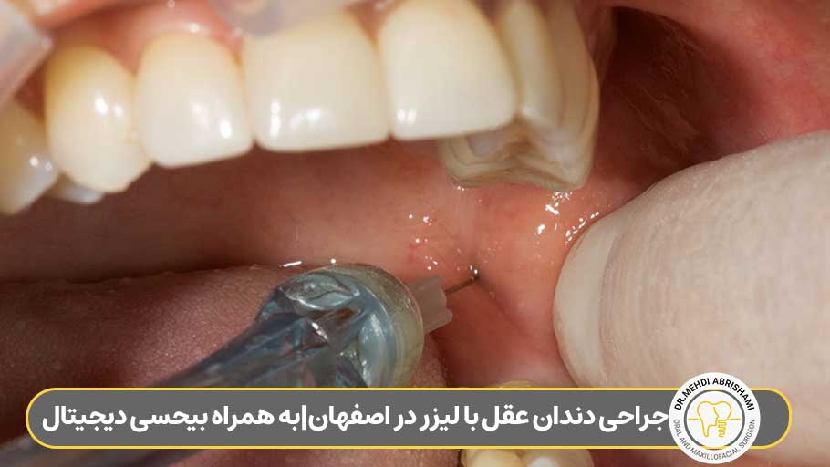 جراحی دندان عقل با لیزر در اصفهان و بیحسی دیجیتال - دکتر مهدی ابریشمی